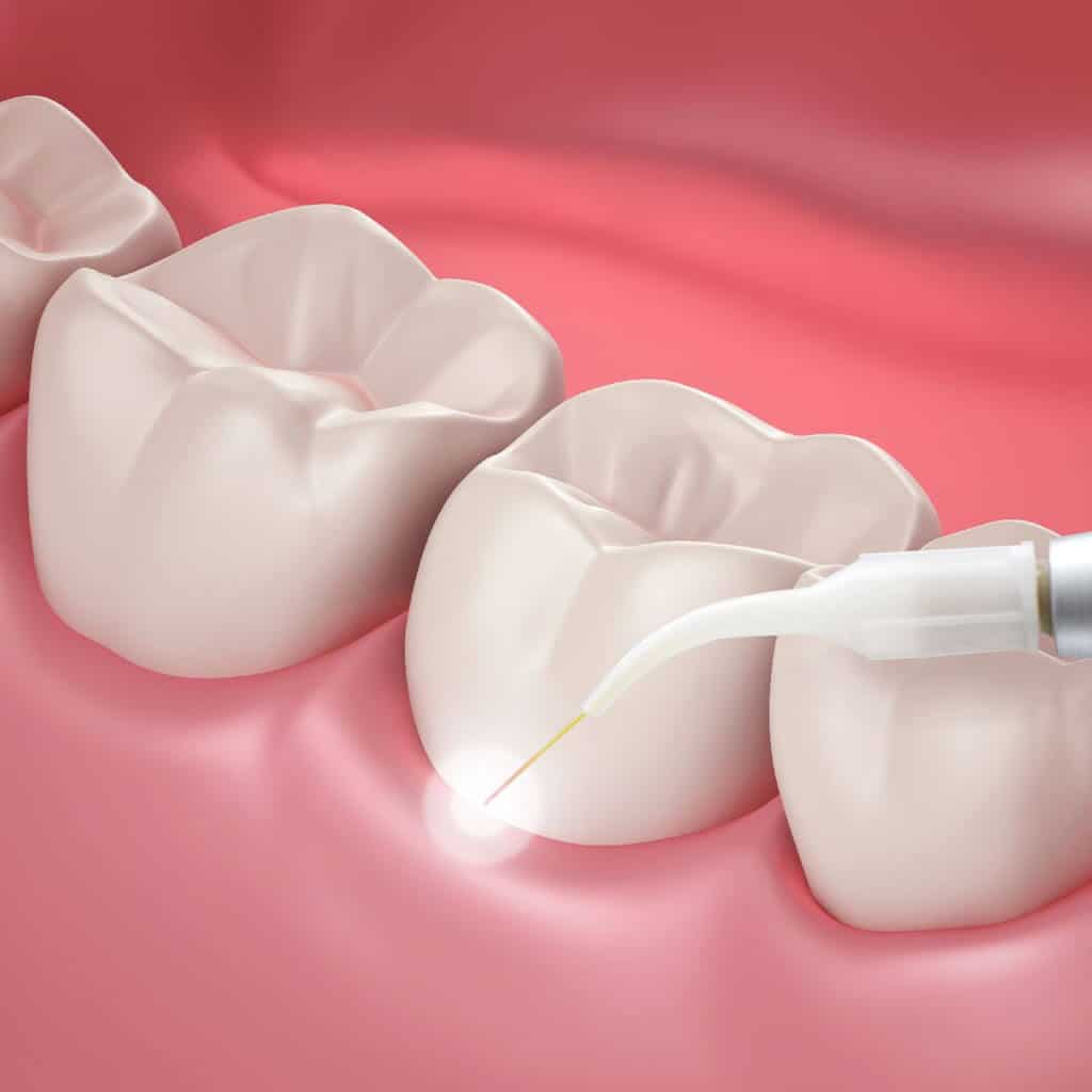 Laser Gum Contouring Dubai