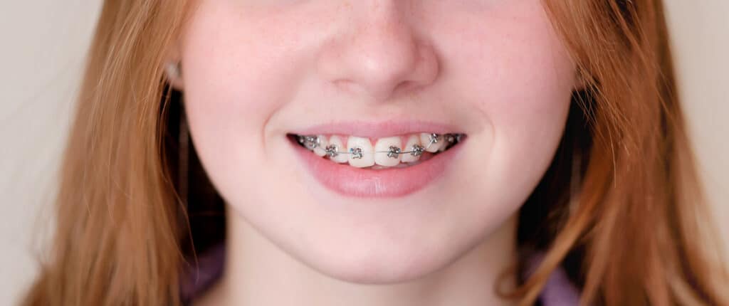 Invisalign vs Traditional Braces | ROZE BioHealth and BioDental Clinics