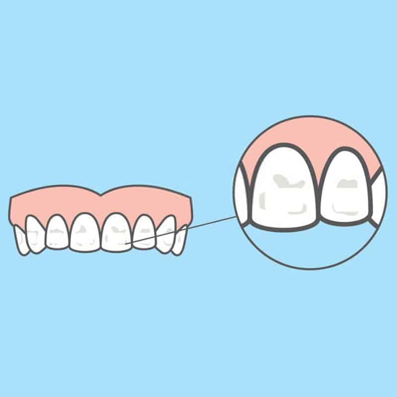 White Spot on the Teeth or your child’s teeth