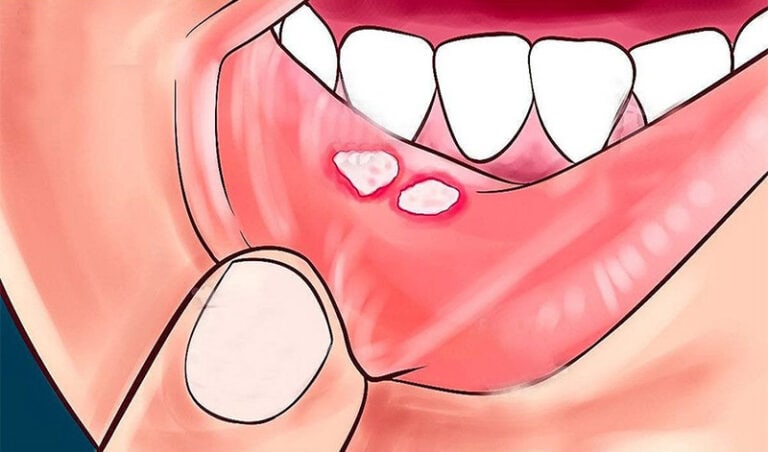 Effective Strategies to Cure Canker Sores